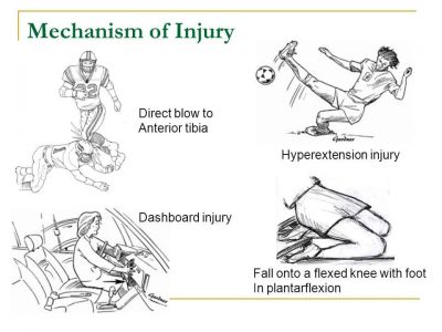 Posterior Cruciate Ligament Injury | Masnad Health Clinic