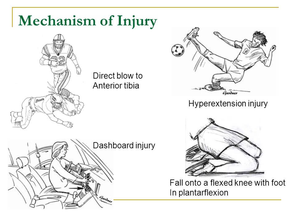 Posterior Cruciate Ligament Injury Masnad Health Clinic Posterior Cruciate Ligament Injury Masnad Health Clinic