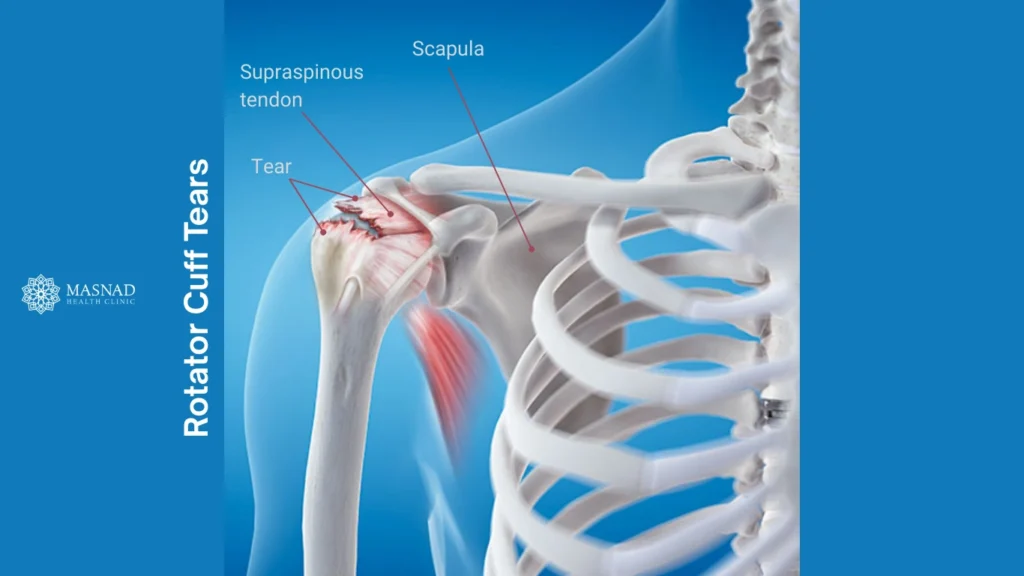 Rotator Cuff Tears | Masnad Health Clinic